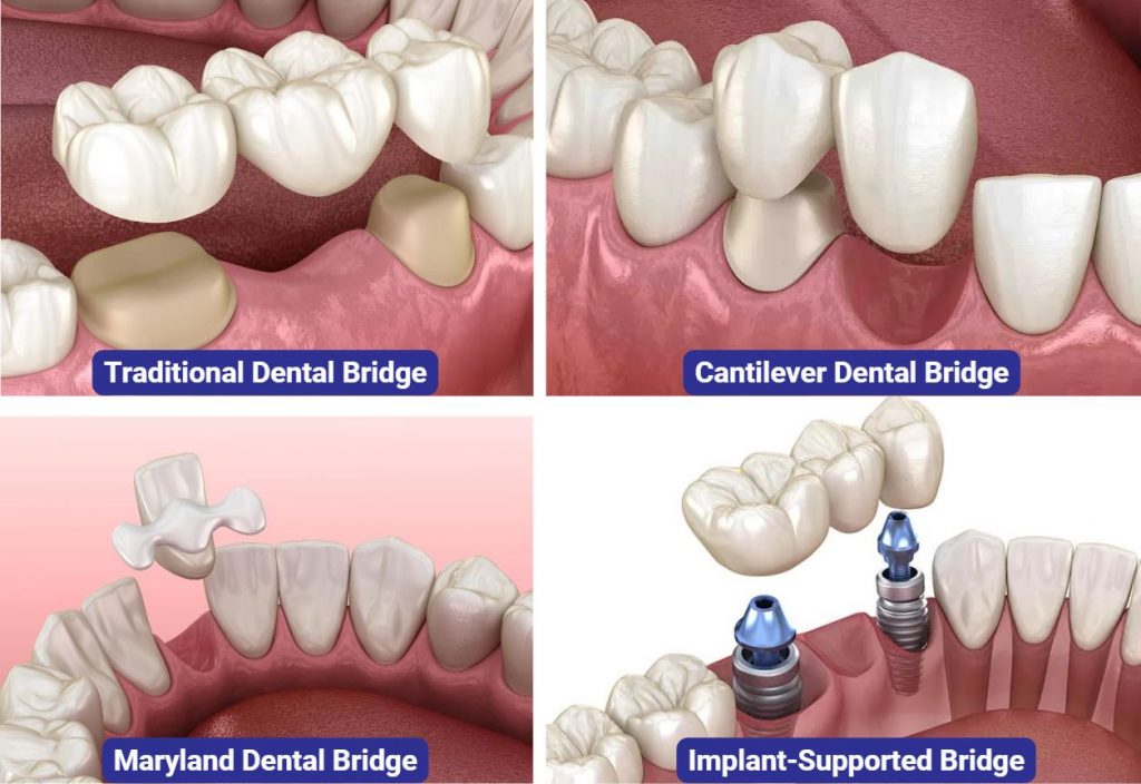 Dental Bridge Cost , Types, FAQ by Dentist in Australia | MC Dental